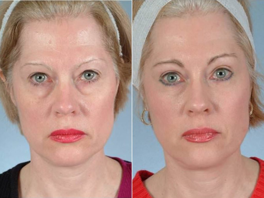 Mid Facelift Before & After Photos | W Cosmetic Surgery