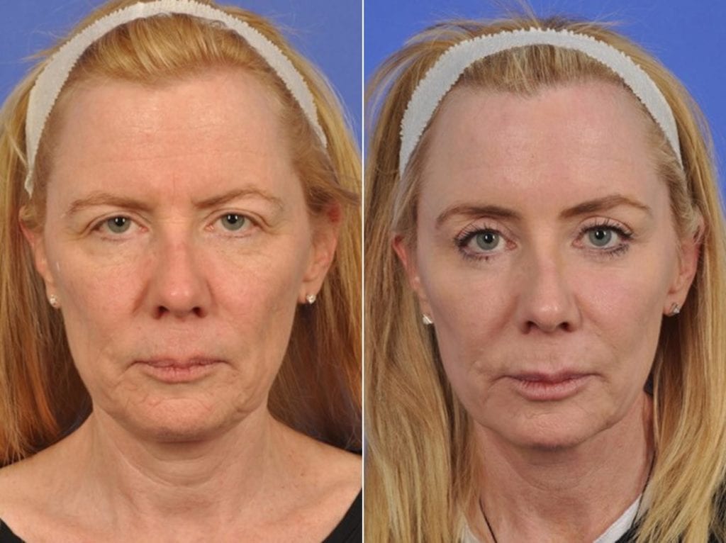 Mid Facelift Before & After Photos | W Cosmetic Surgery