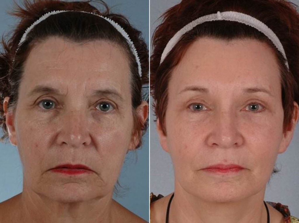 Mid Facelift Before & After Photos | W Cosmetic Surgery