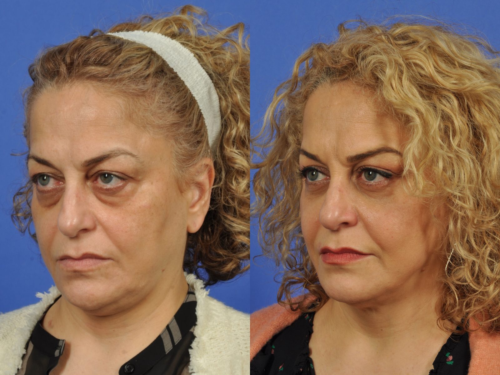 Mid Facelift Before & After Photos | W Cosmetic Surgery