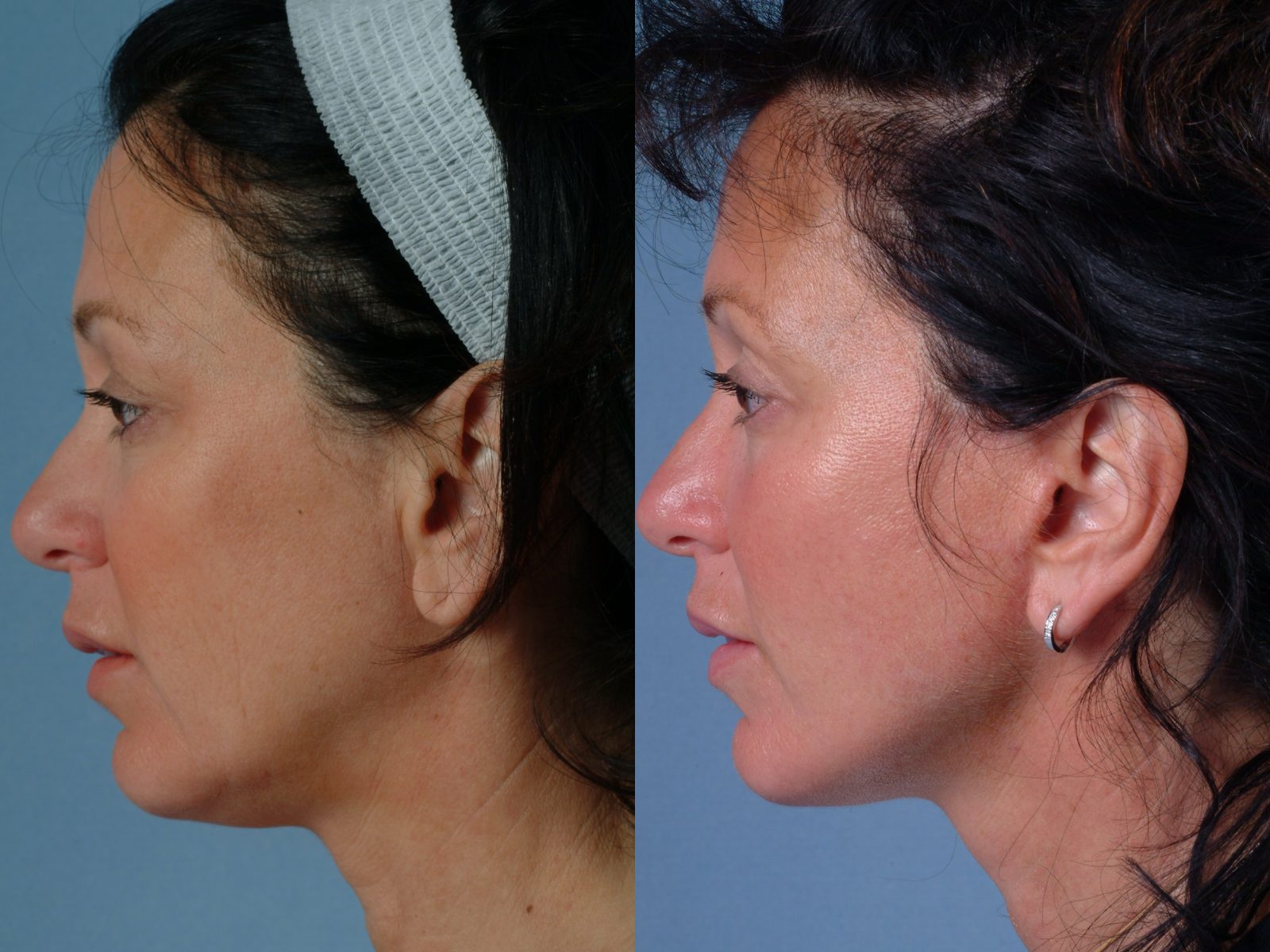 Mini Facelift Before & After Photos | W Cosmetic Surgery
