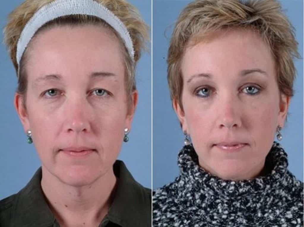 Mini Facelift Before & After Photos | W Cosmetic Surgery