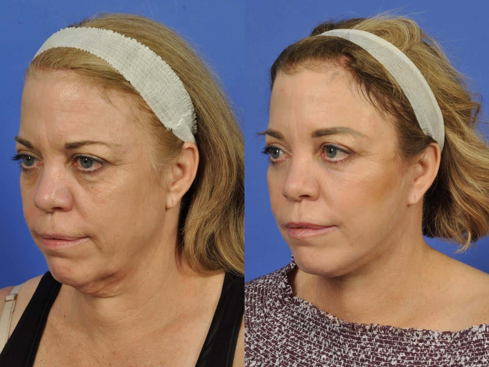 Neck Lift Before & After Photos | W Cosmetic Surgery