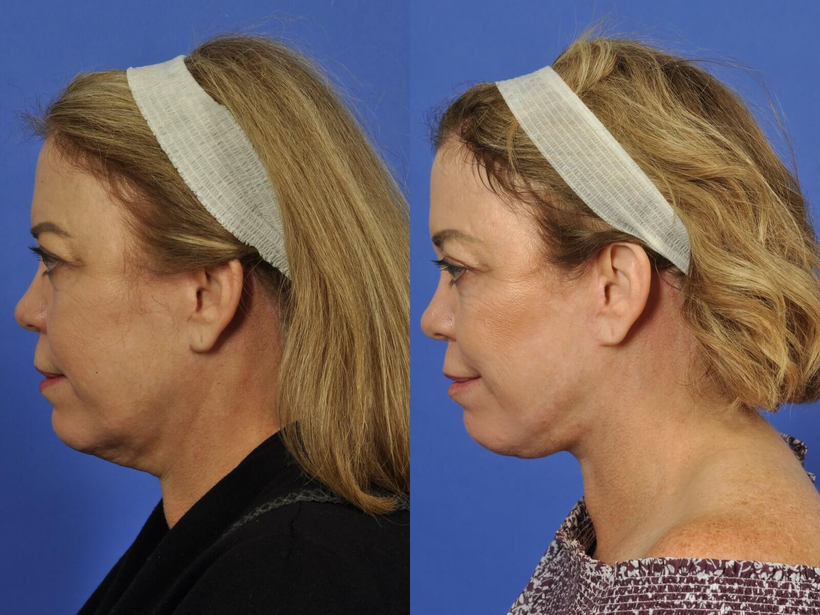 Neck Lift Before & After Photos | W Cosmetic Surgery