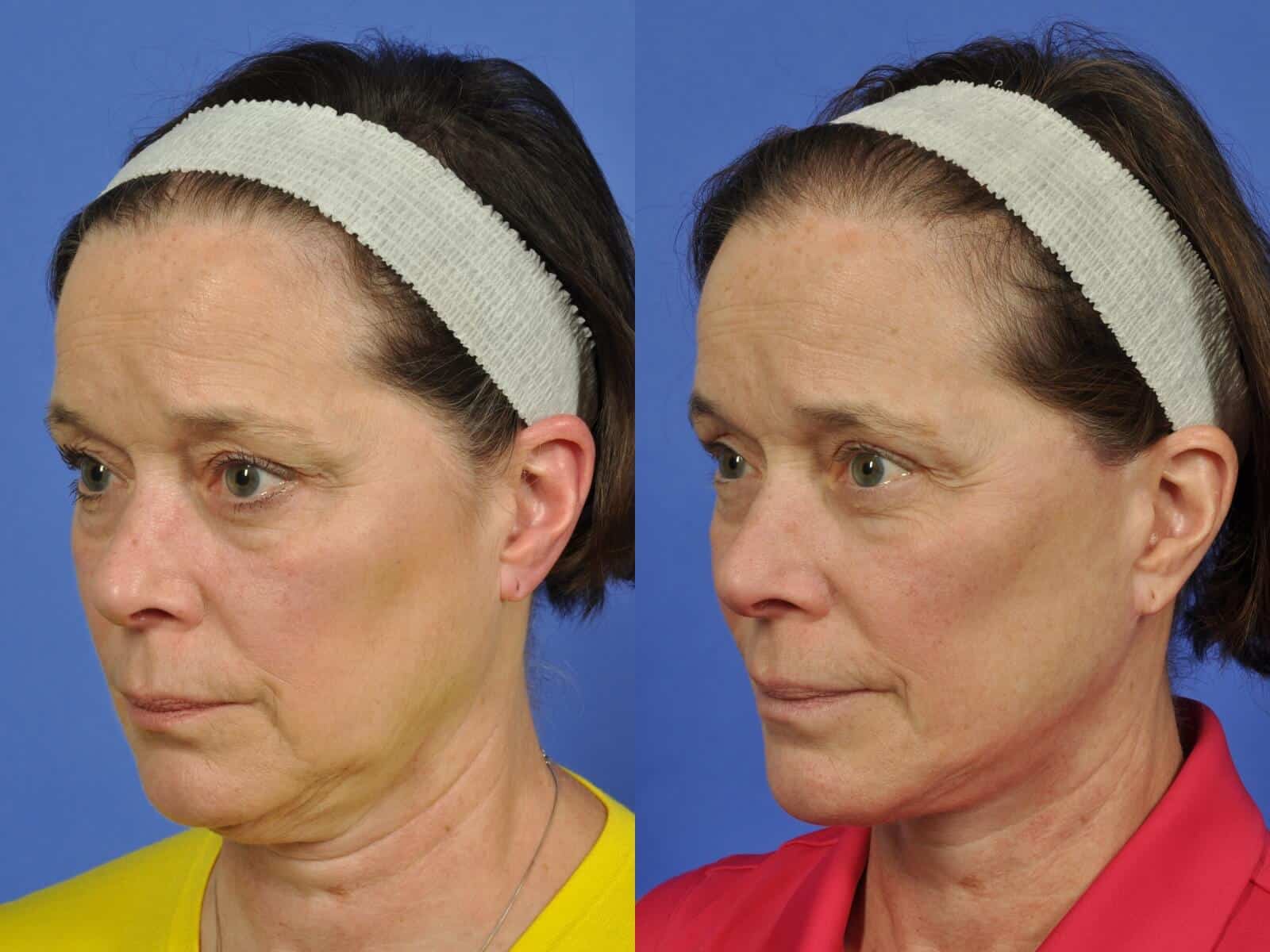 Neck Lift Before & After Photos | W Cosmetic Surgery