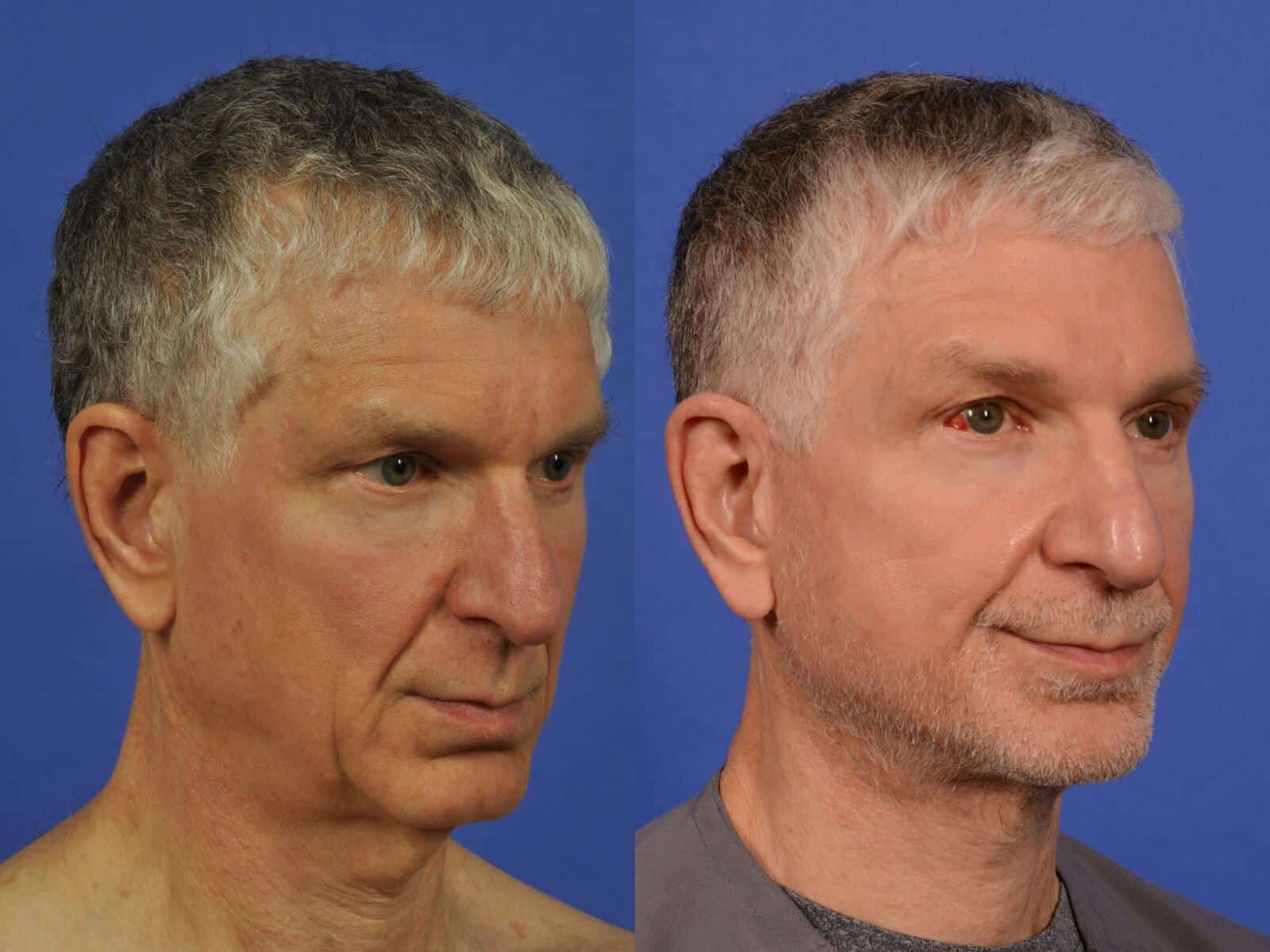 Neck Lift Before & After Photos | W Cosmetic Surgery