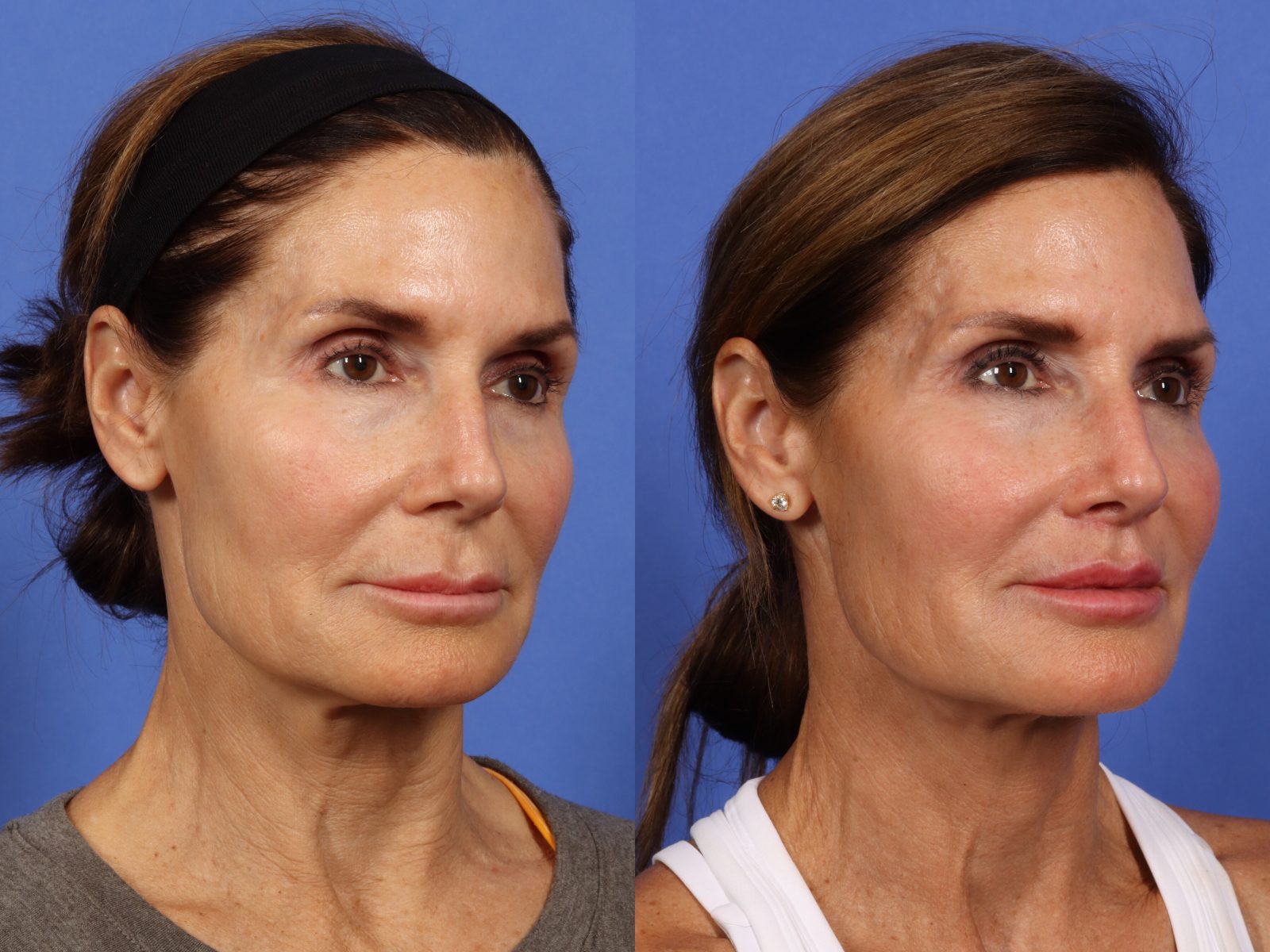 Synergy Lift Before & After Photos | W Cosmetic Surgery