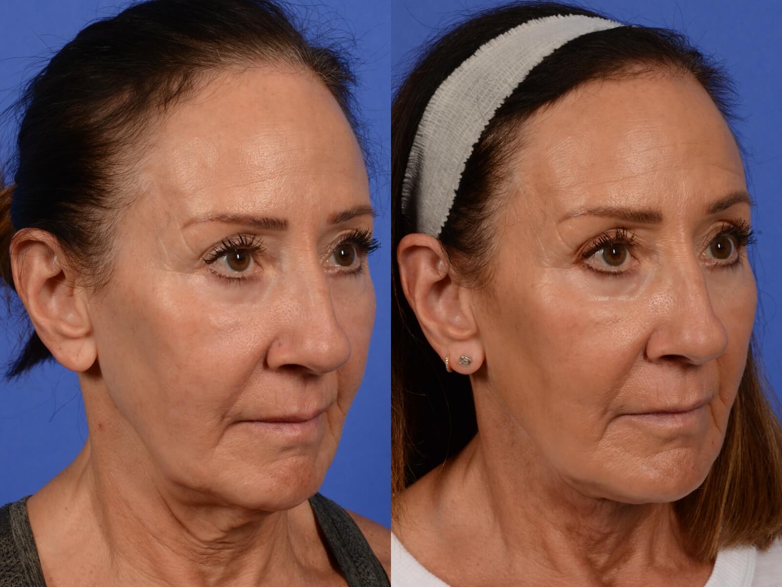 Synergy Lift Before & After Photos | W Cosmetic Surgery