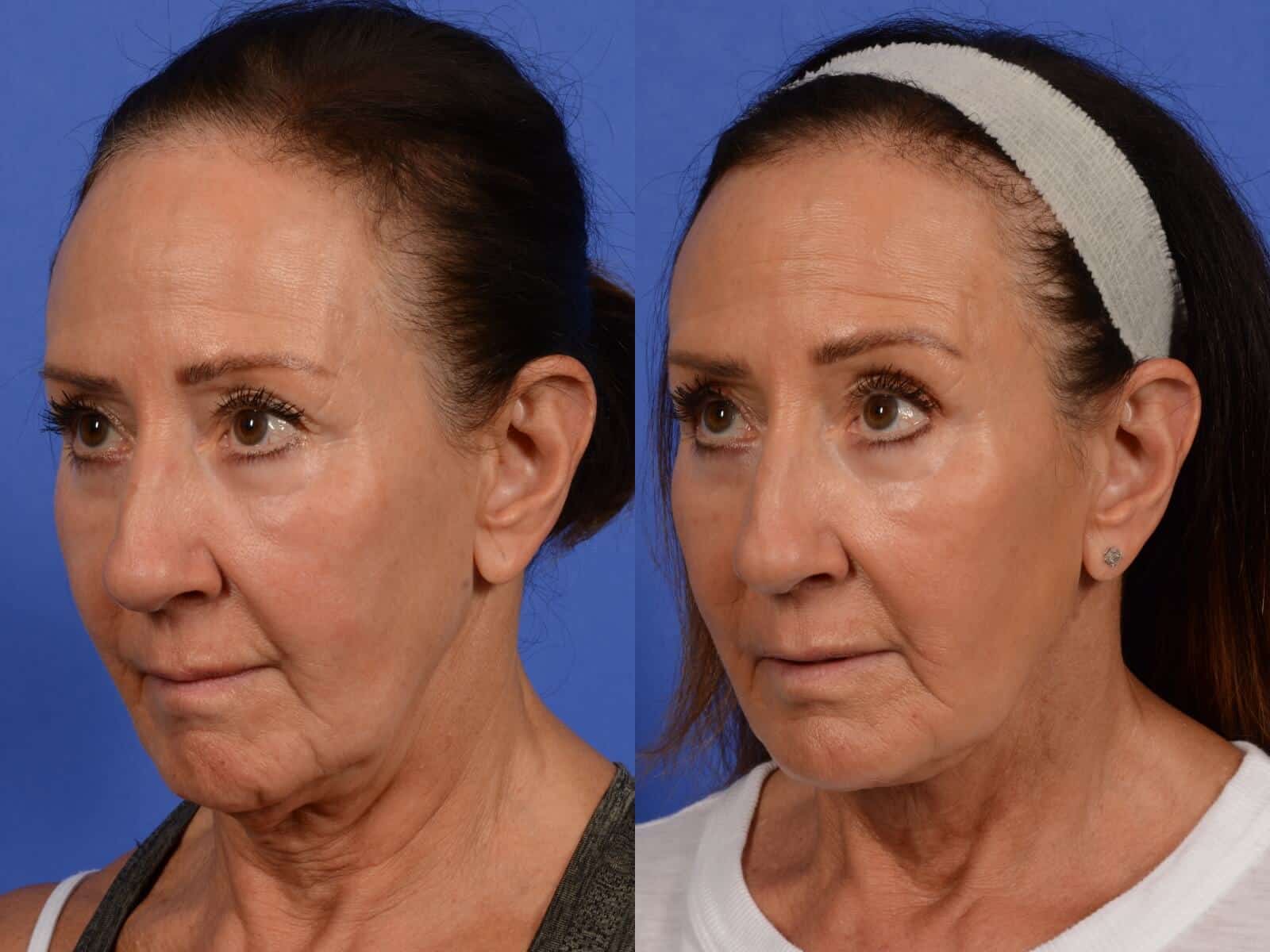 Synergy Lift Before & After Photos | W Cosmetic Surgery