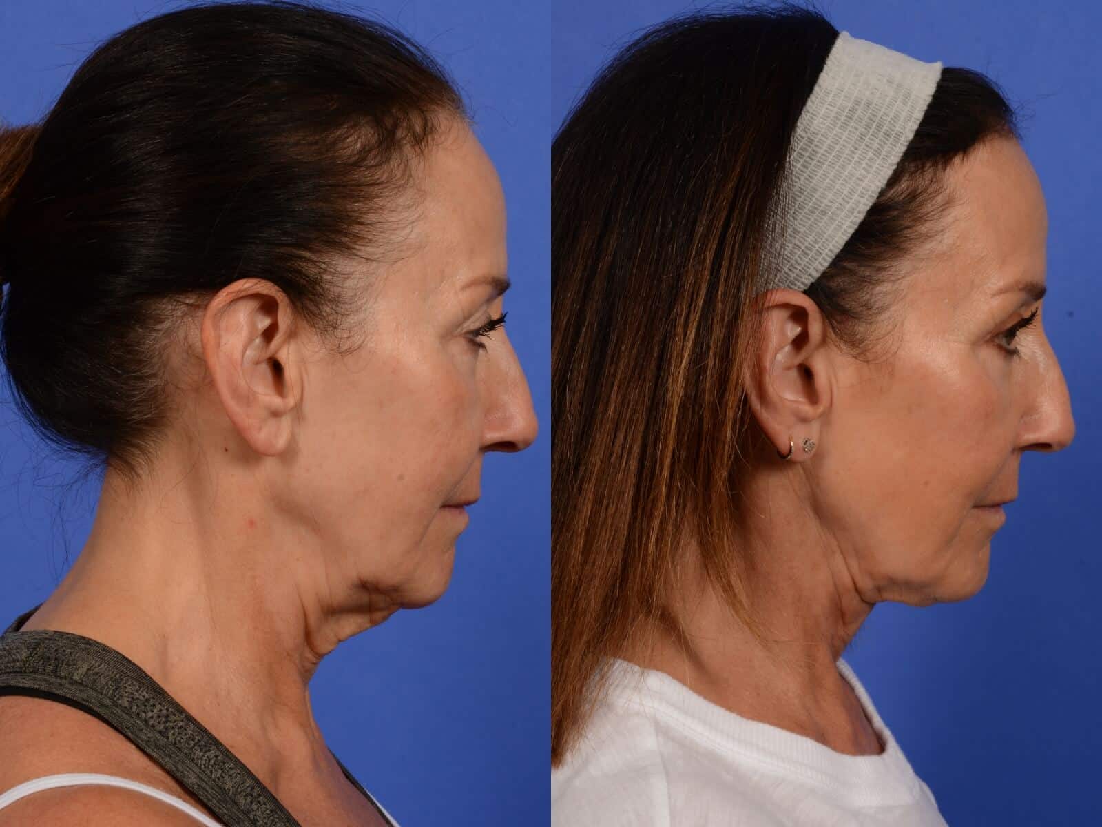 Synergy Lift Before & After Photos | W Cosmetic Surgery