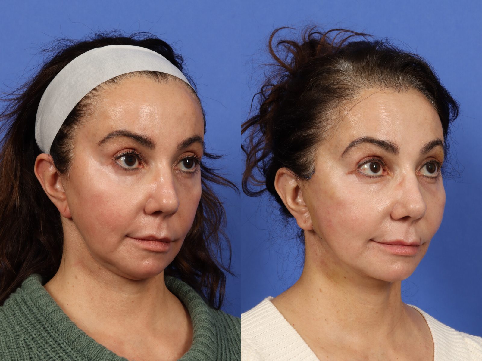 Synergy Lift Before & After Photos | W Cosmetic Surgery