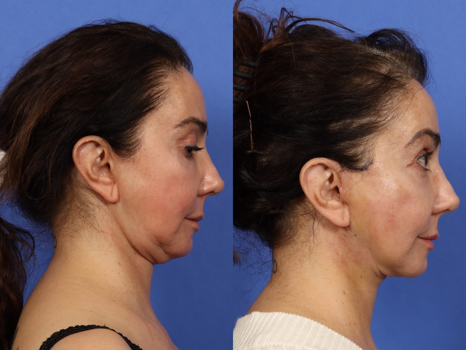 Synergy Lift Before & After Photos | W Cosmetic Surgery