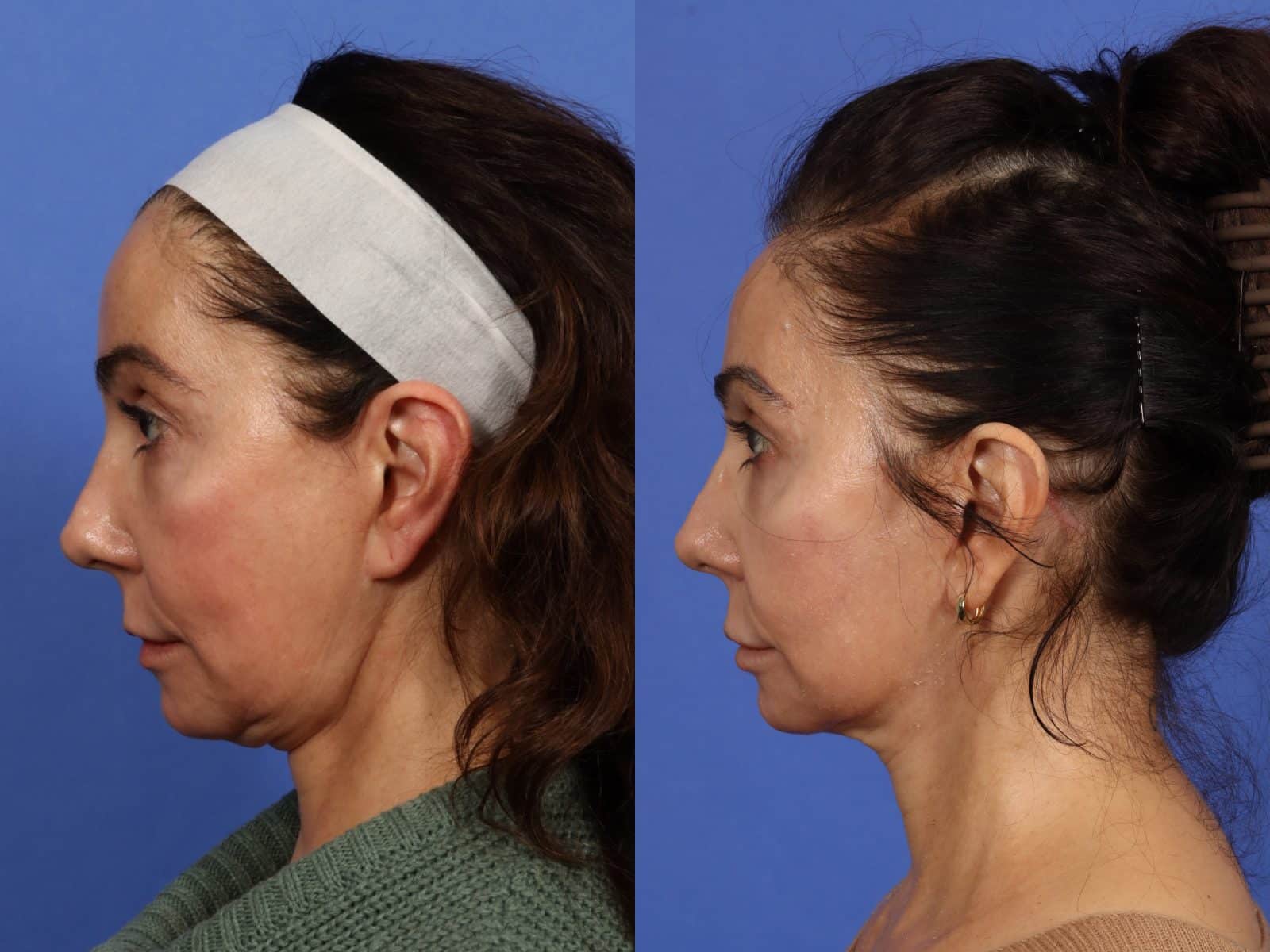 Synergy Lift Before & After Photos | W Cosmetic Surgery