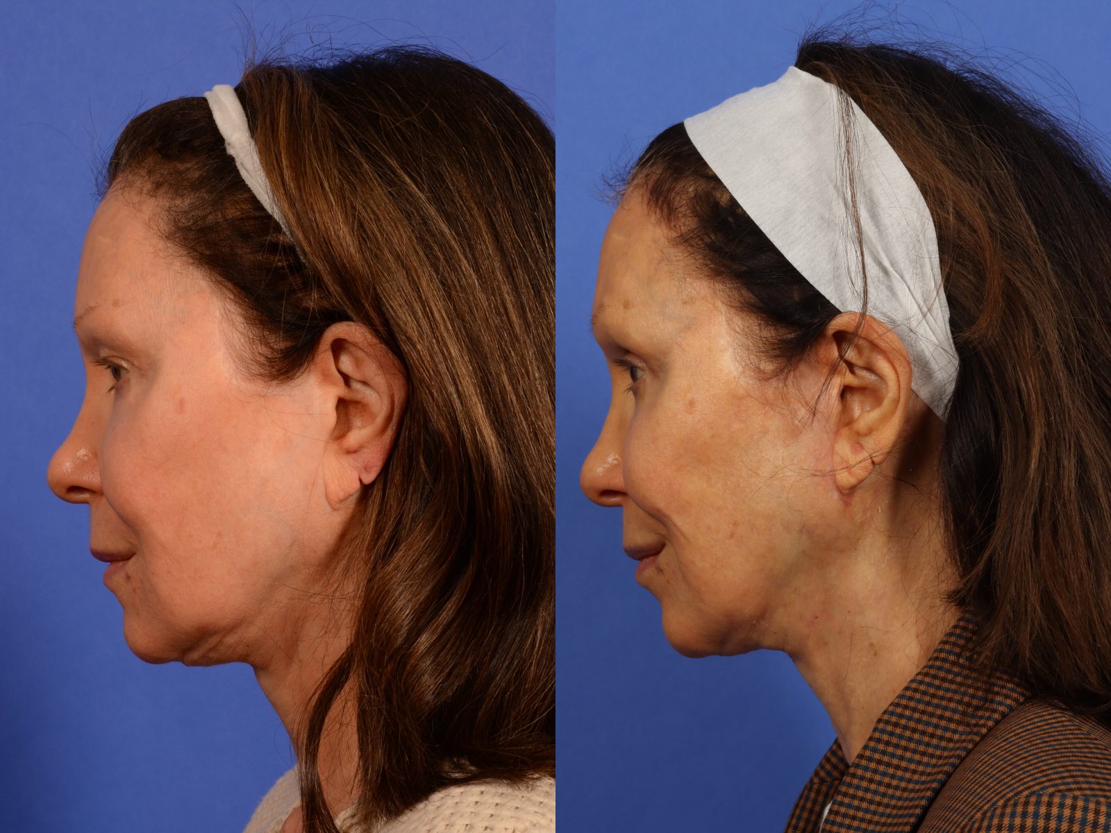 Synergy Lift Before & After Photos | W Cosmetic Surgery