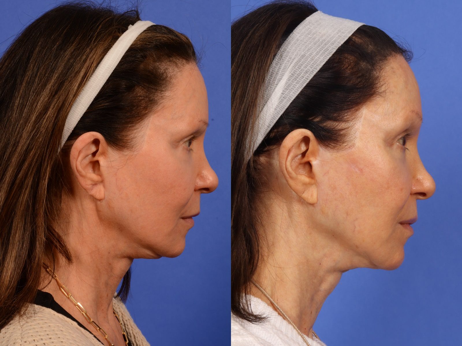 Synergy Lift Before & After Photos | W Cosmetic Surgery