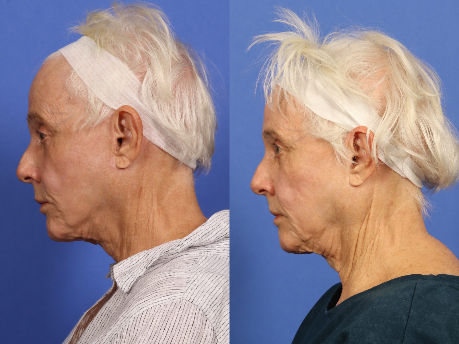 Synergy Lift Before & After Photos | W Cosmetic Surgery