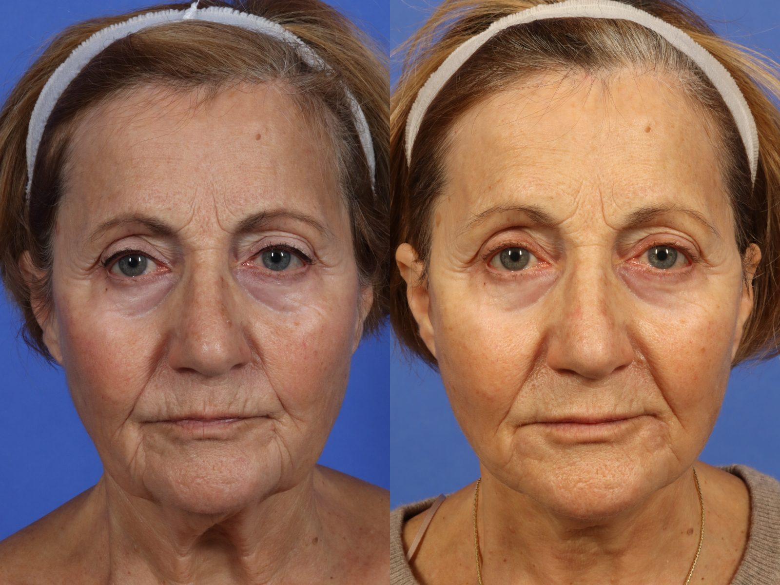 Synergy Lift Before & After Photos | W Cosmetic Surgery