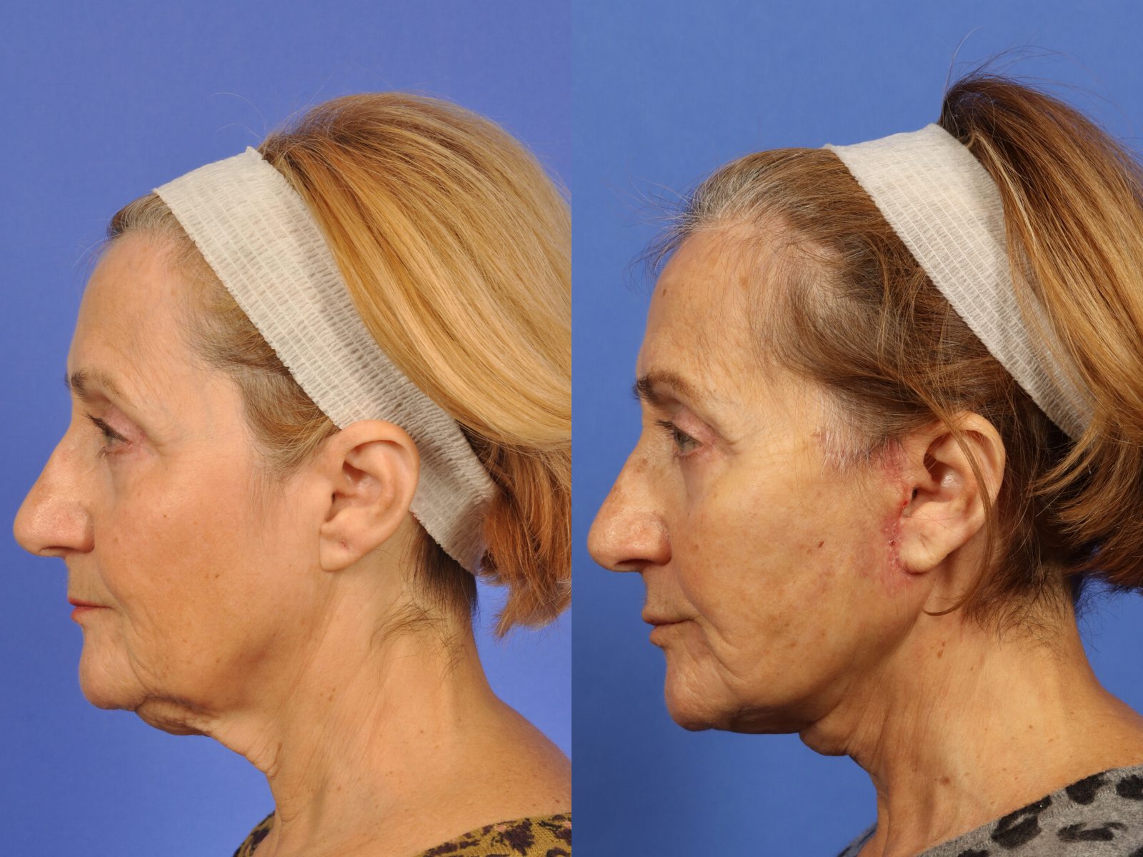 Synergy Lift Before & After Photos | W Cosmetic Surgery