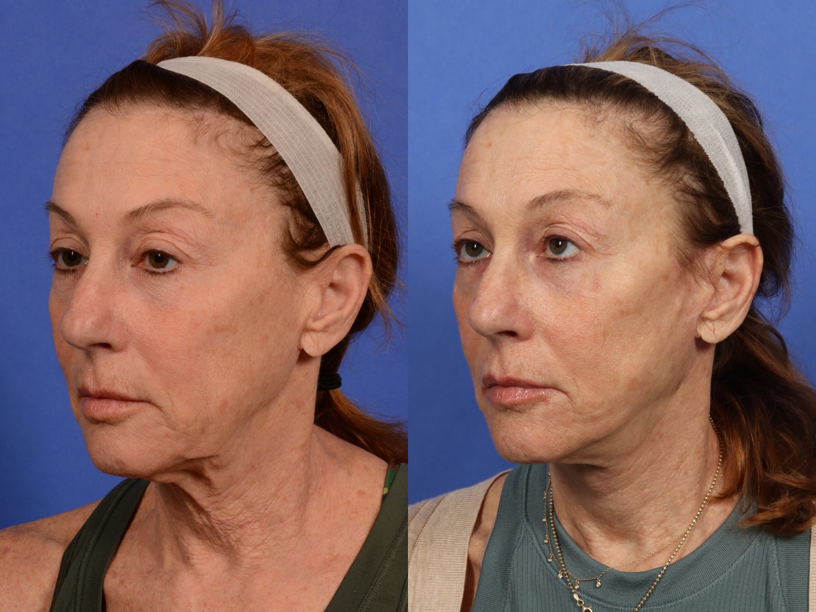 Synergy Lift Before & After Photos | W Cosmetic Surgery
