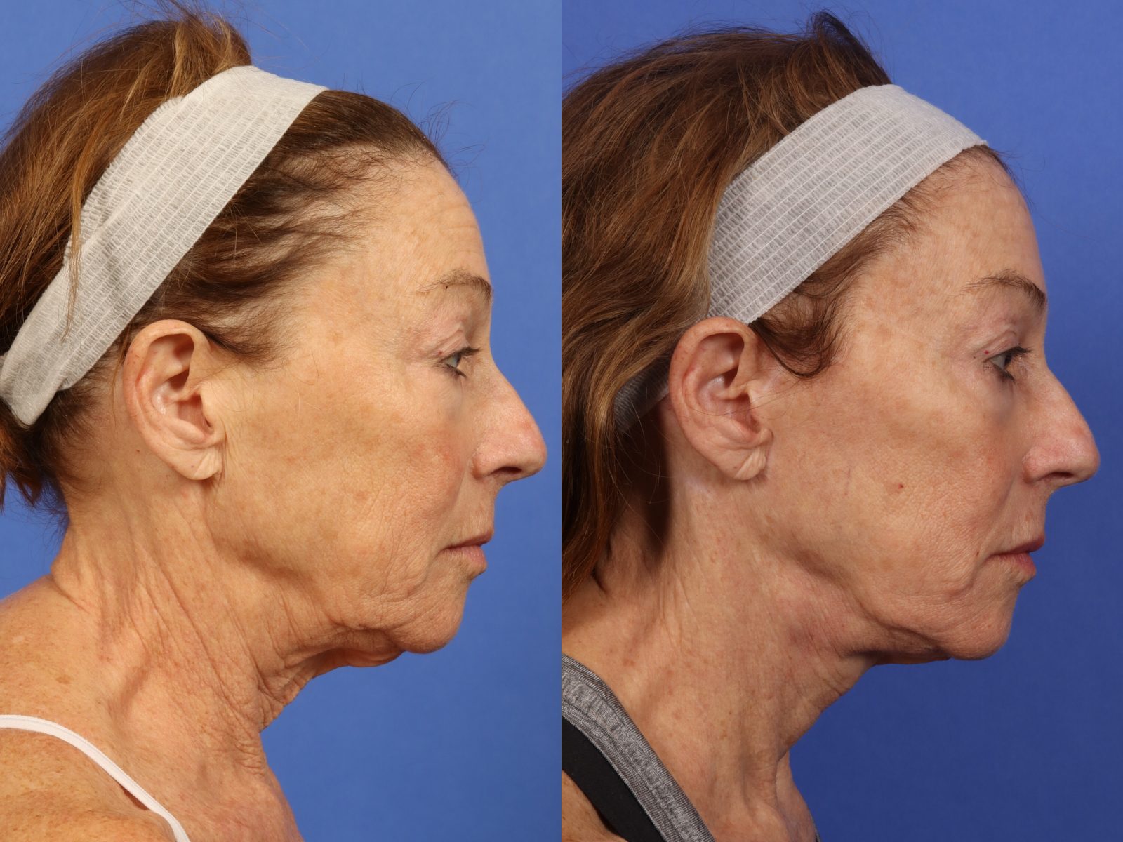 Synergy Lift Before & After Photos | W Cosmetic Surgery