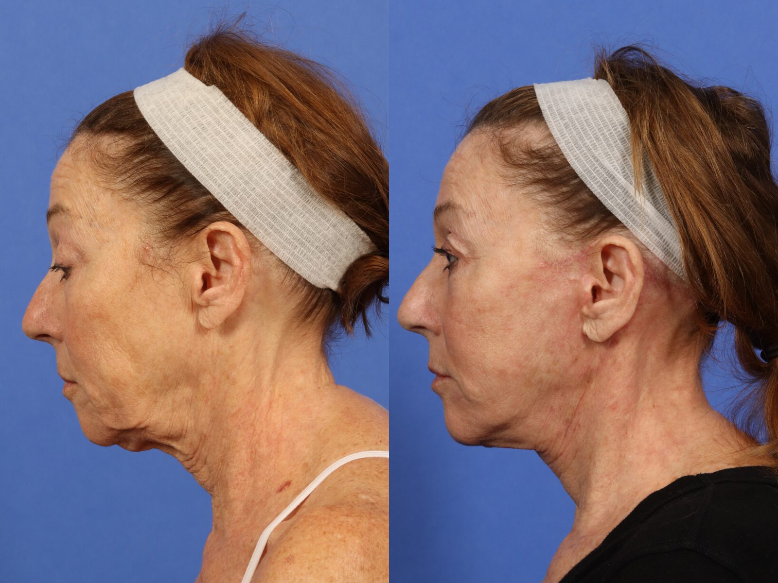Synergy Lift Before & After Photos | W Cosmetic Surgery