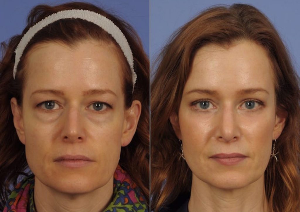 Patient 112110 | WNatural Micromidfacelift™ Before & After Photos | W ...