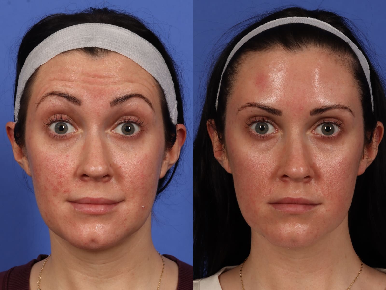 BOTOX® Before & After Photos | W Cosmetic Surgery