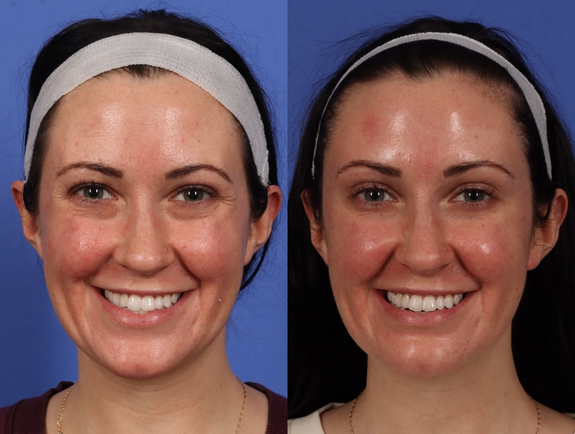 BOTOX® Before & After Photos | W Cosmetic Surgery