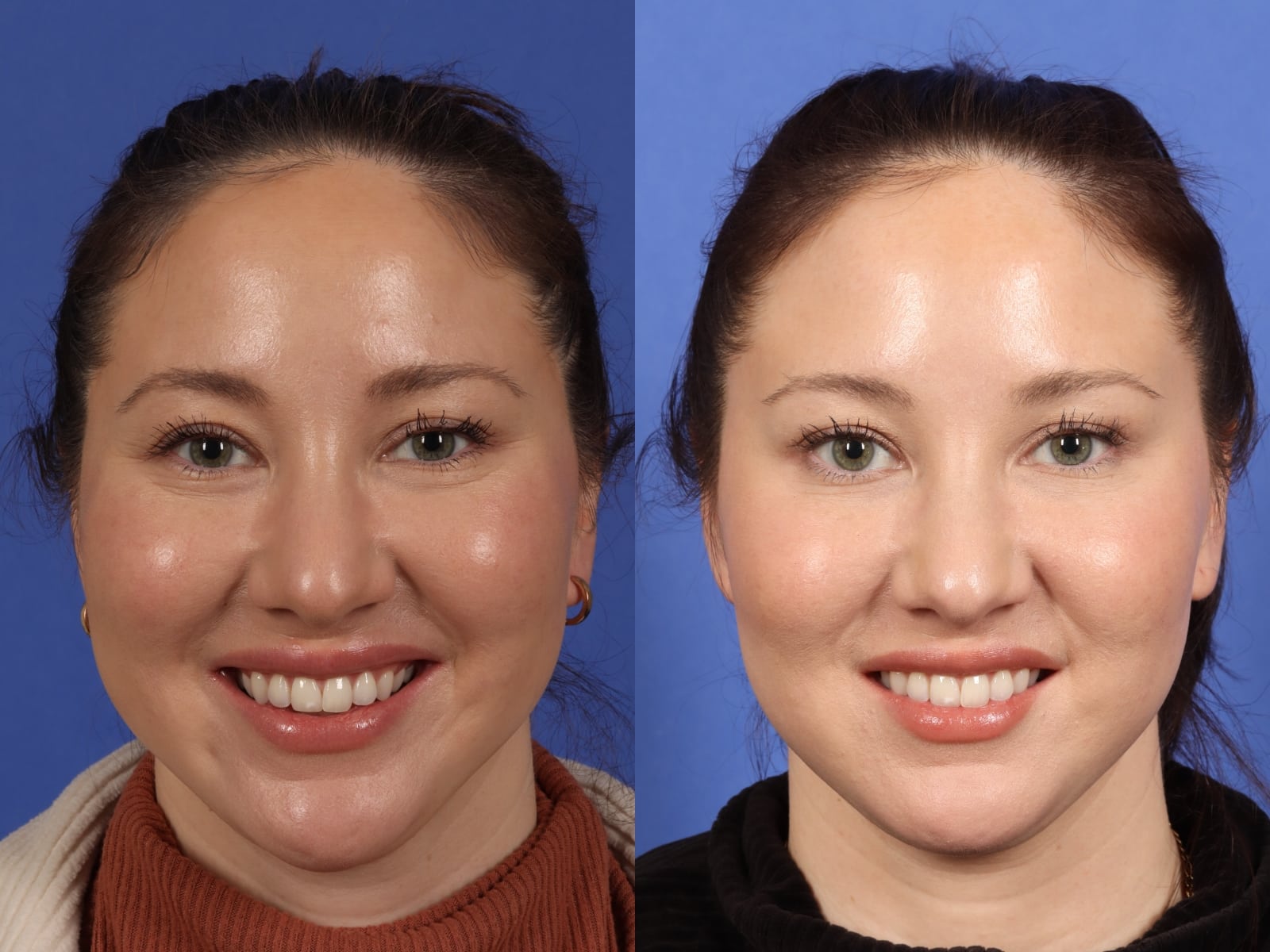 BOTOX® Before & After Photos | W Cosmetic Surgery