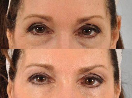BOTOX® Before & After Photos | W Cosmetic Surgery