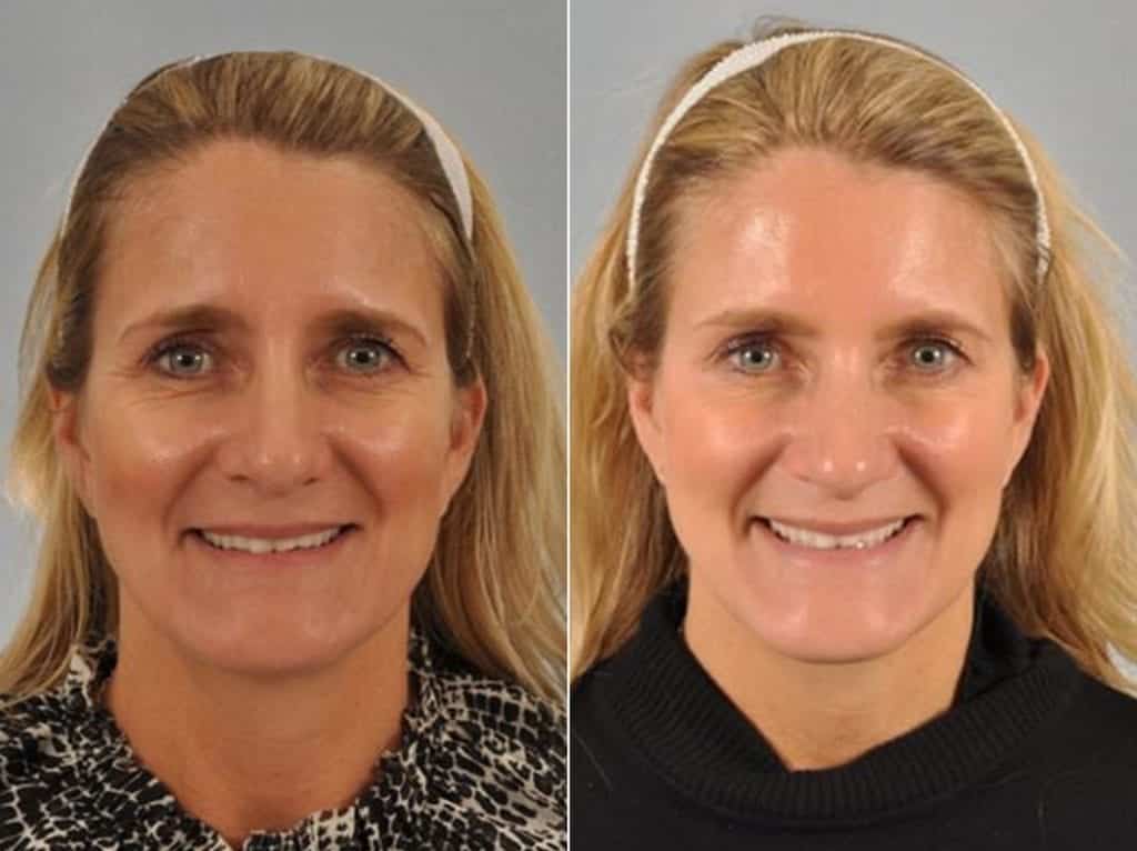 BOTOX® Before & After Photos | W Cosmetic Surgery