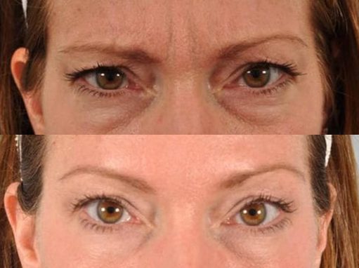 BOTOX® Before & After Photos | W Cosmetic Surgery