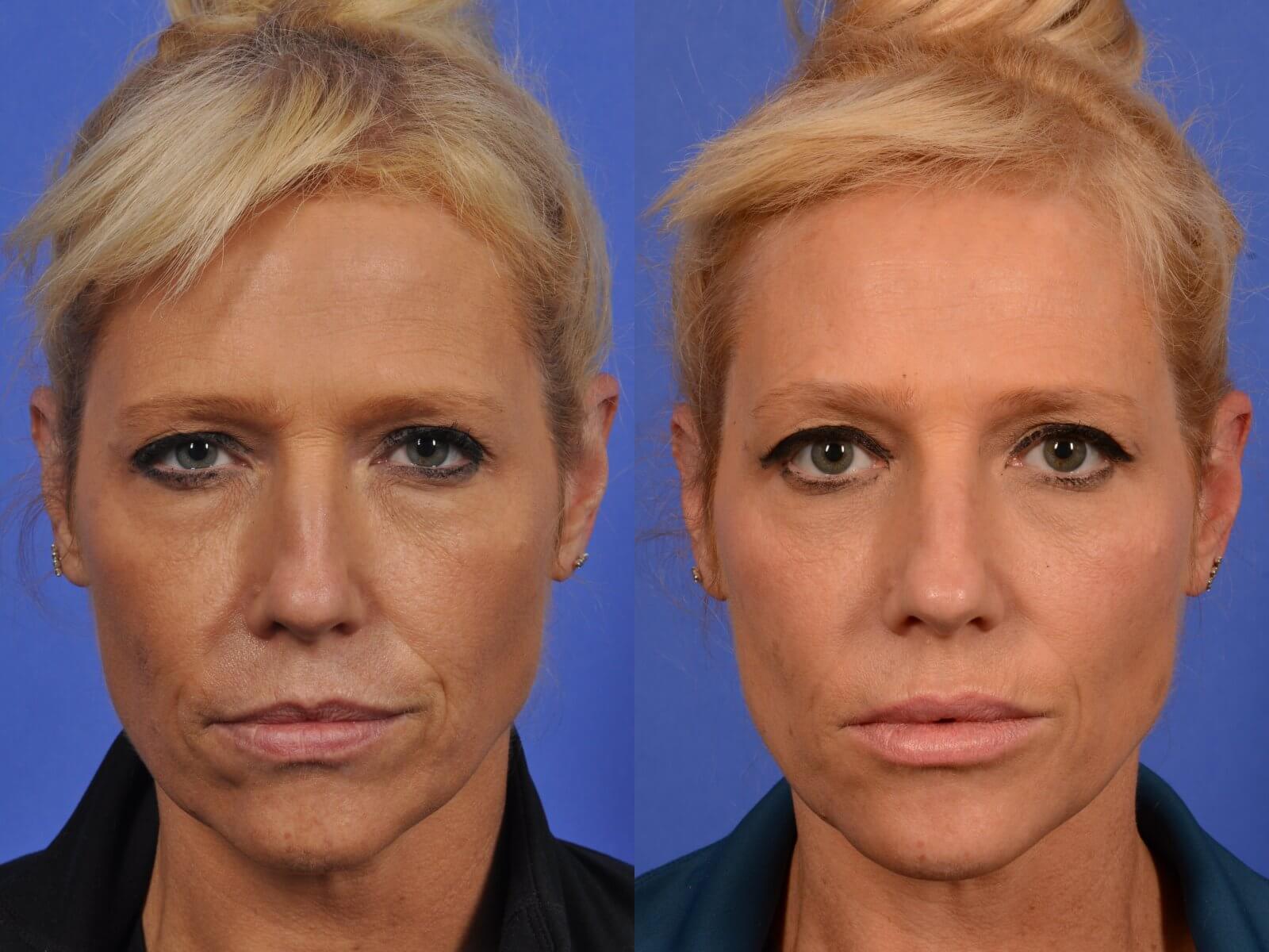 Fillers Before & After Photos | W Cosmetic Surgery