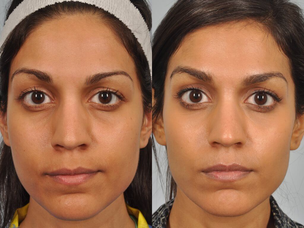 Tear Trough Filler Before & After Photos | W Cosmetic Surgery