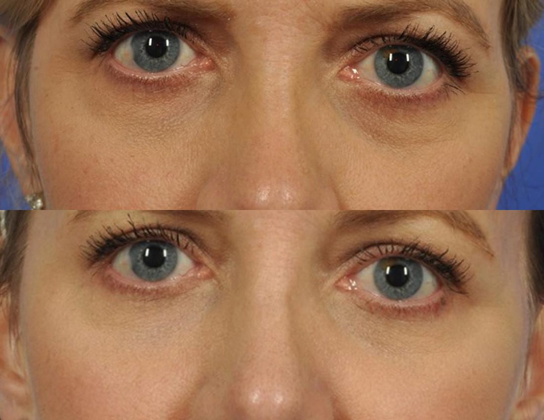 Tear Trough Filler Before & After Photos | W Cosmetic Surgery