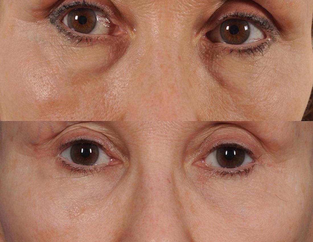 Tear Trough Filler Before & After Photos | W Cosmetic Surgery