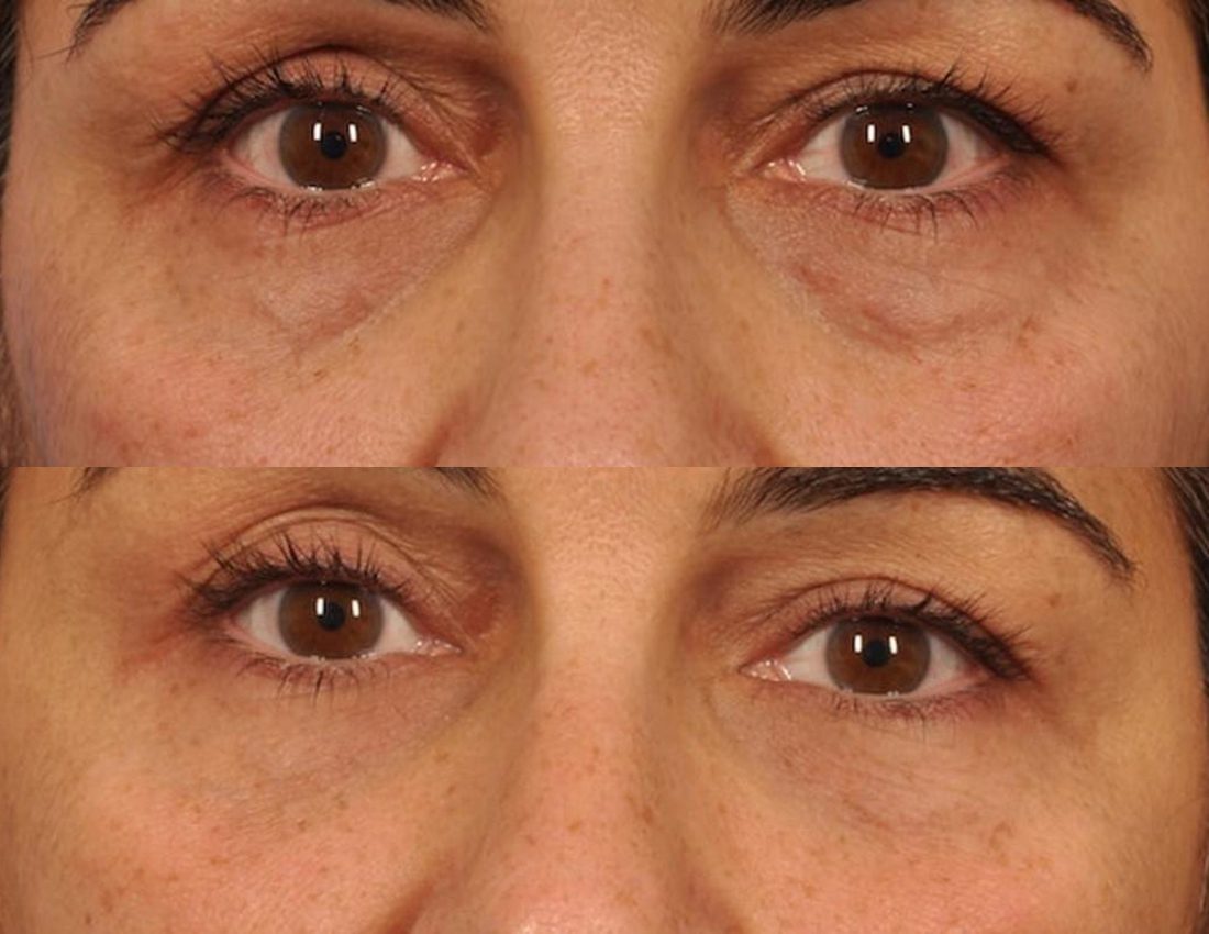 Tear Trough Filler Before & After Photos | W Cosmetic Surgery
