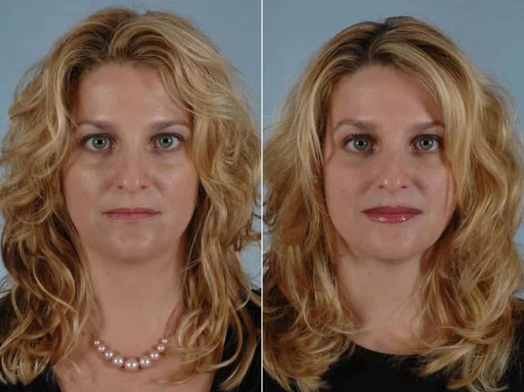 Tear Trough Filler Before & After Photos | W Cosmetic Surgery
