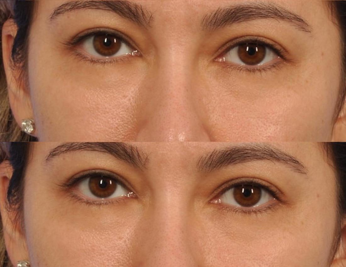 Tear Trough Filler Before & After Photos | W Cosmetic Surgery