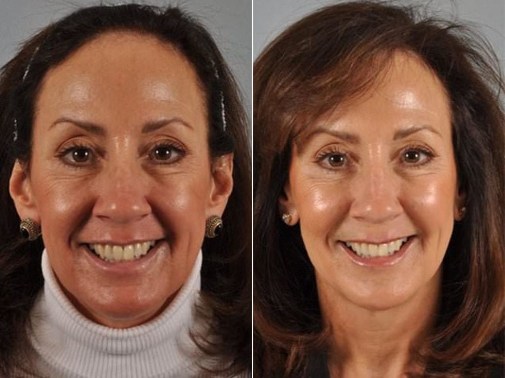 Tear Trough Filler Before & After Photos | W Cosmetic Surgery