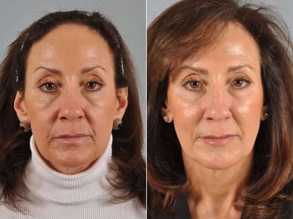 Tear Trough Filler Before & After Photos | W Cosmetic Surgery