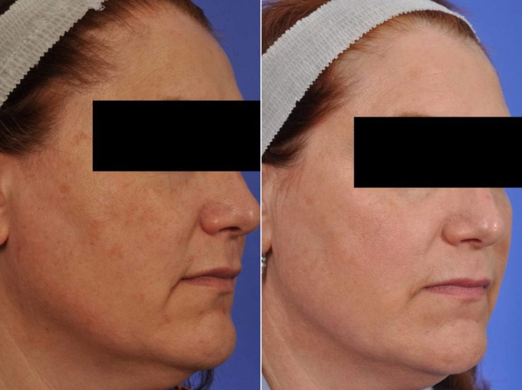 BBL (IPL Treatments) Before & After Photos | W Cosmetic Surgery