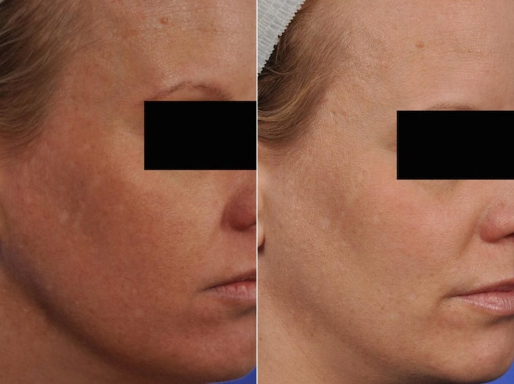BBL (IPL Treatments) Before & After Photos | W Cosmetic Surgery