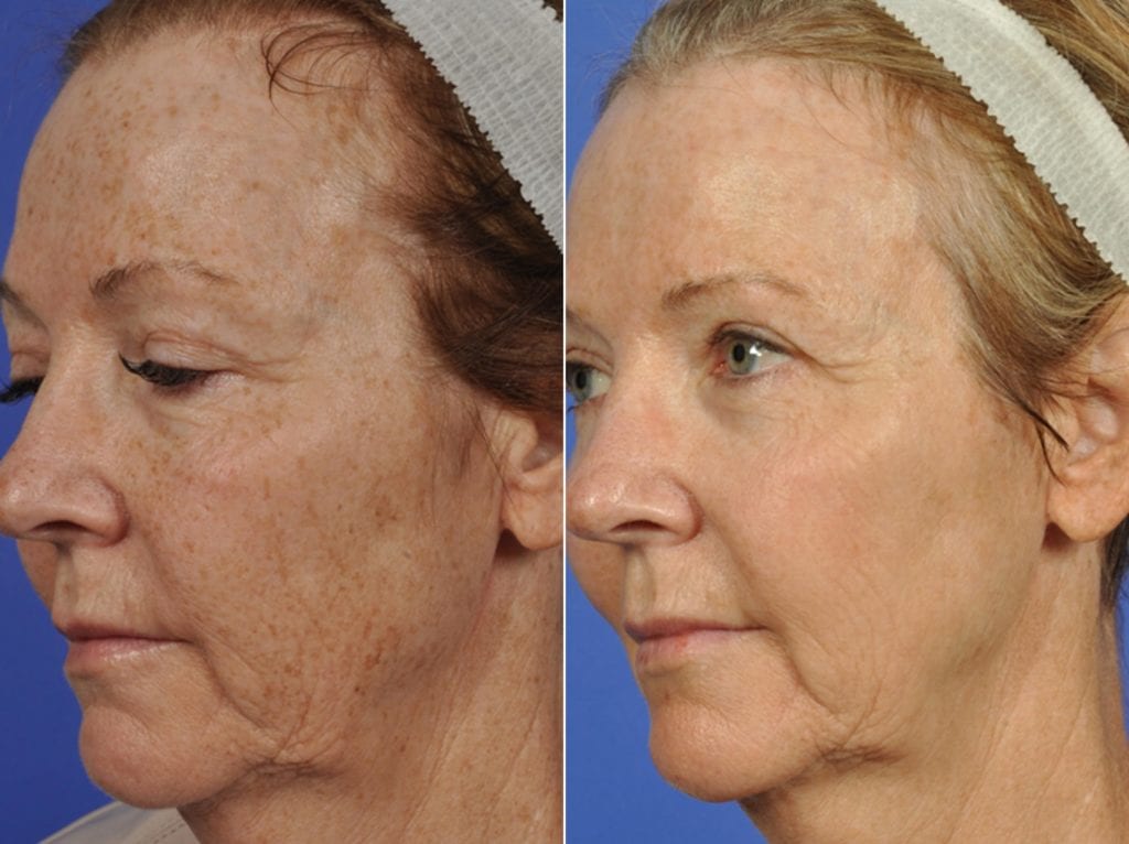 BBL (IPL Treatments) Before & After Photos | W Cosmetic Surgery