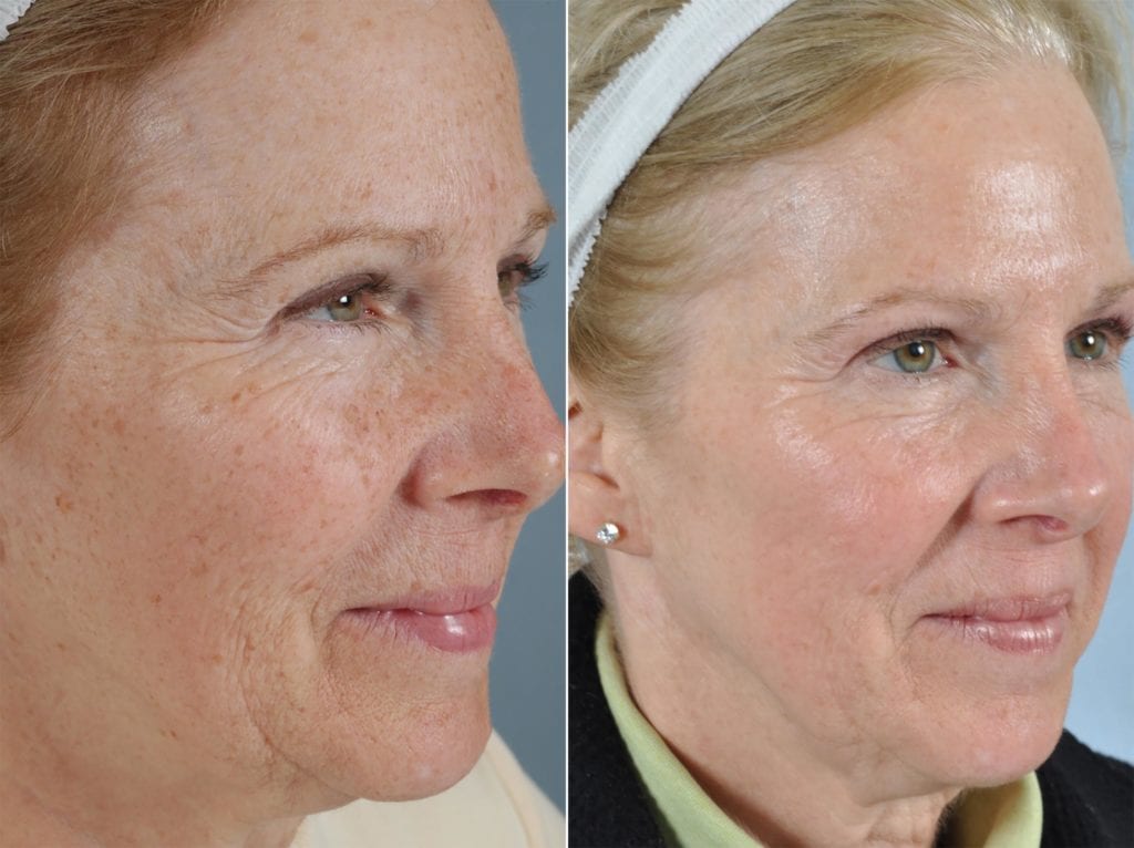 BBL (IPL Treatments) Before & After Photos | W Cosmetic Surgery