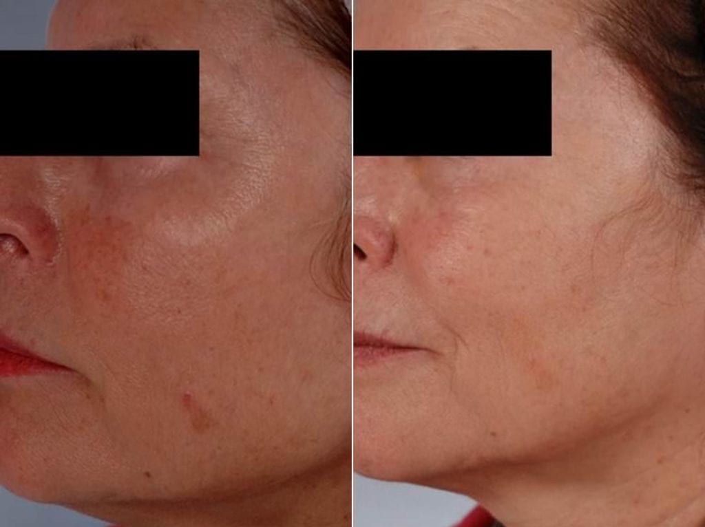 BBL (IPL Treatments) Before & After Photos | W Cosmetic Surgery