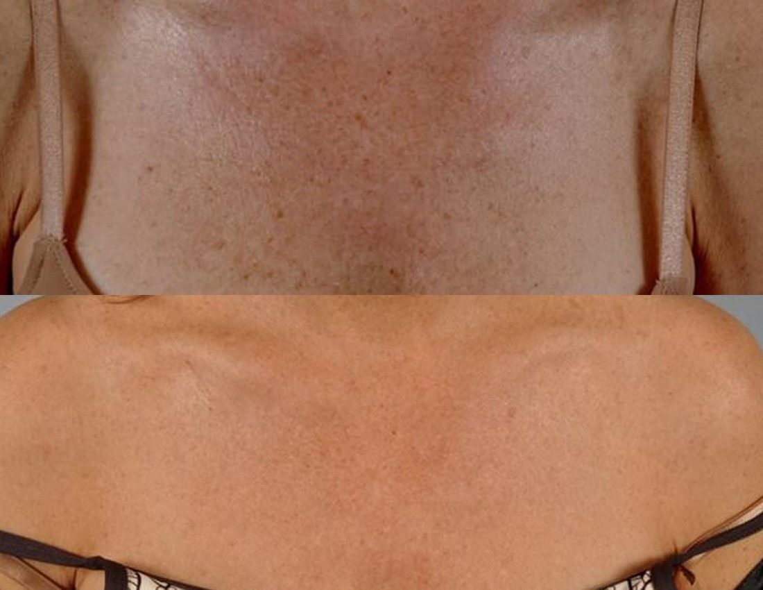 BBL (IPL Treatments) Before & After Photos | W Cosmetic Surgery