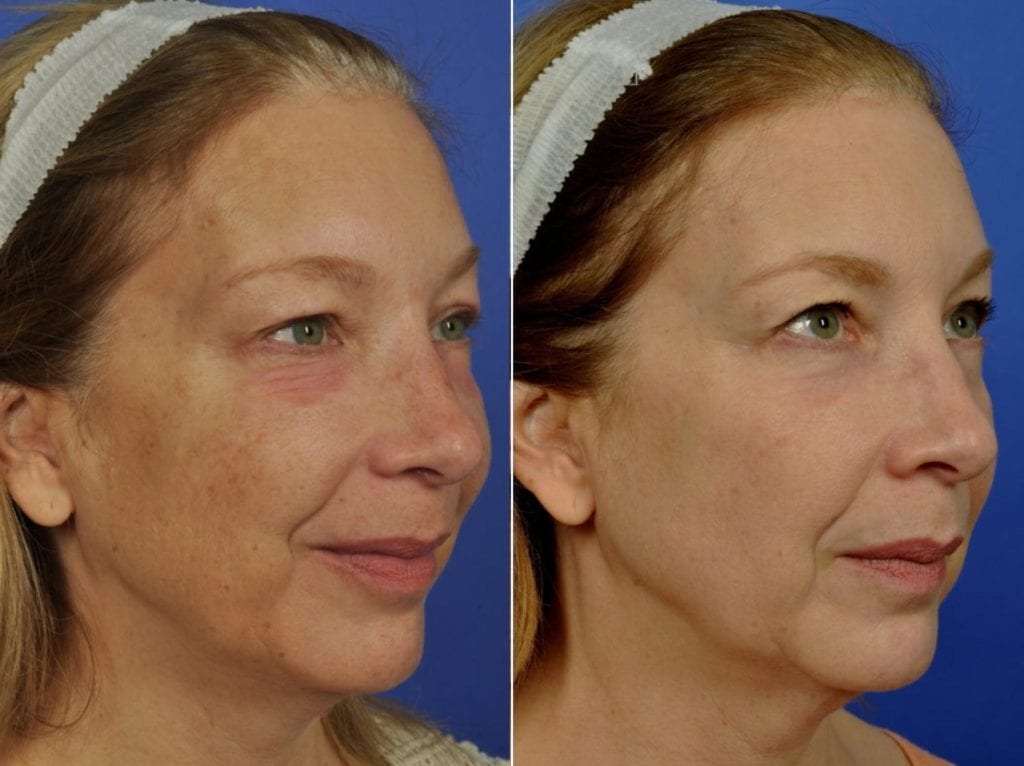 BBL (IPL Treatments) Before & After Photos | W Cosmetic Surgery