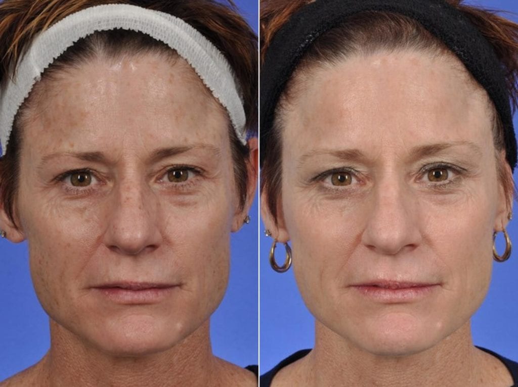 BBL (IPL Treatments) Before & After Photos | W Cosmetic Surgery