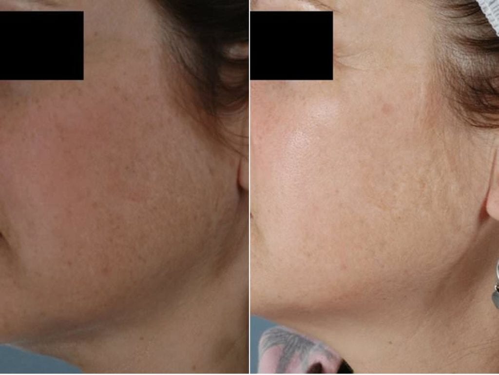 BBL (IPL Treatments) Before & After Photos | W Cosmetic Surgery